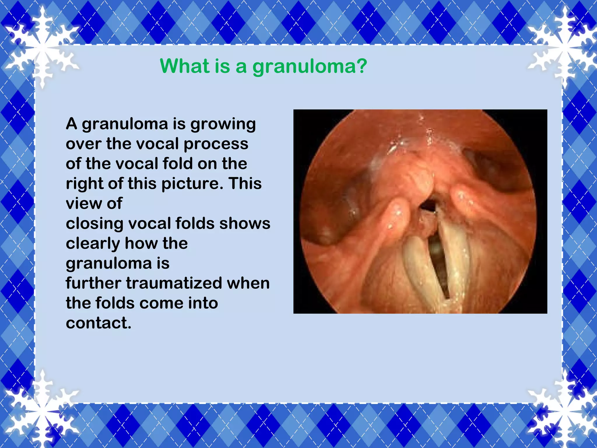 Vocal cord granuloma | PPT