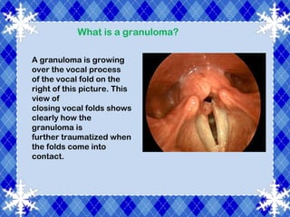 Vocal cord granuloma | PPT
