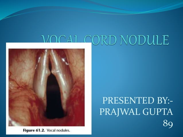 Vocal cord nodule | PPT