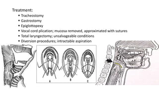 Vocal cord palsy | PPTX