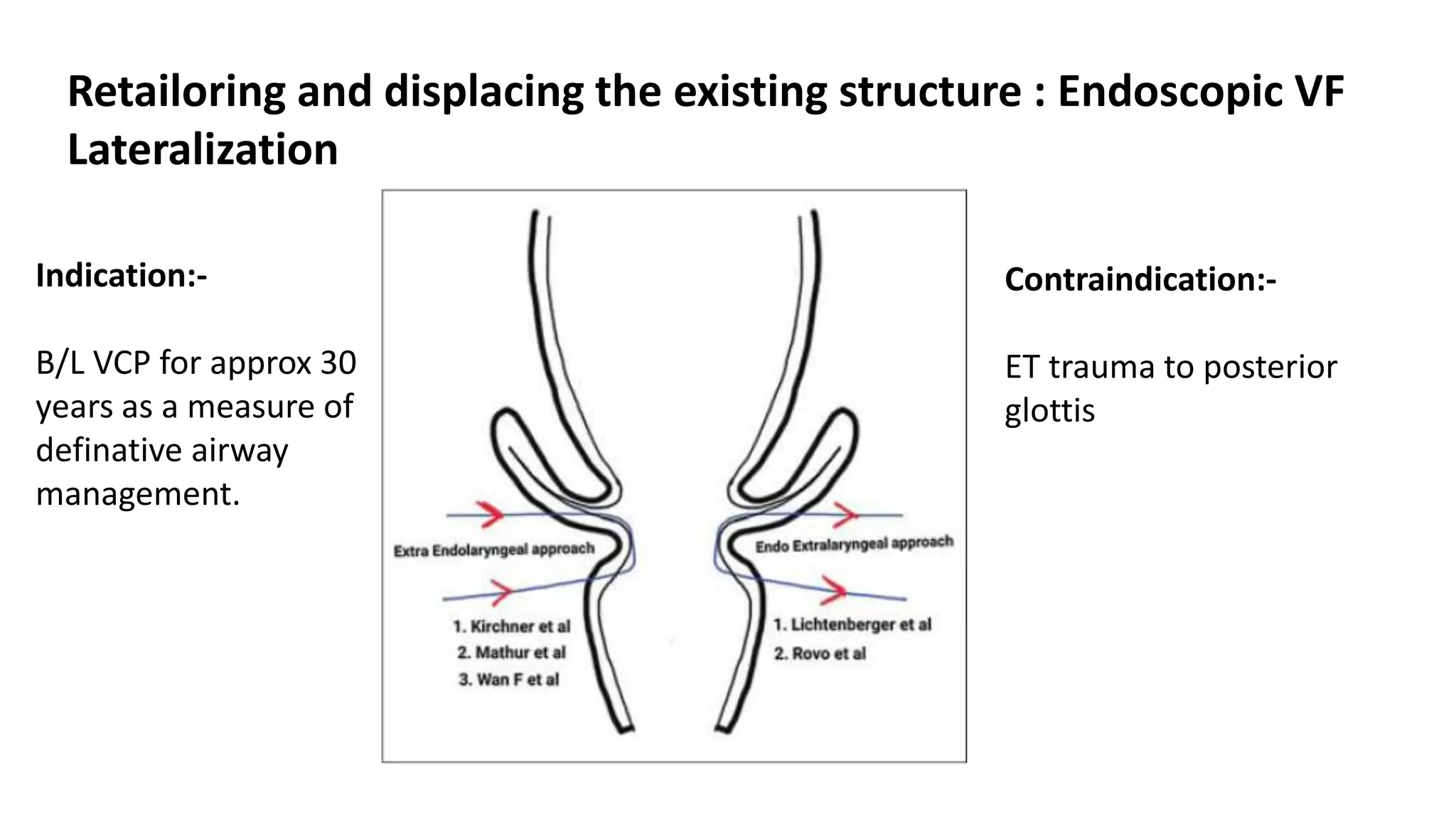 Vocal cord palsy | PPTX