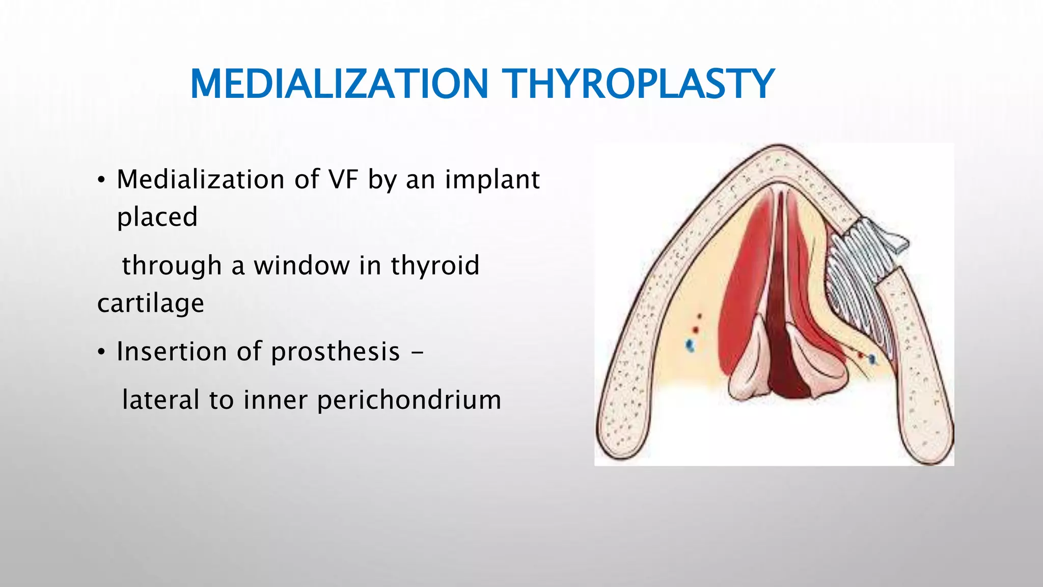 Vocal cord paralysis | PPTX