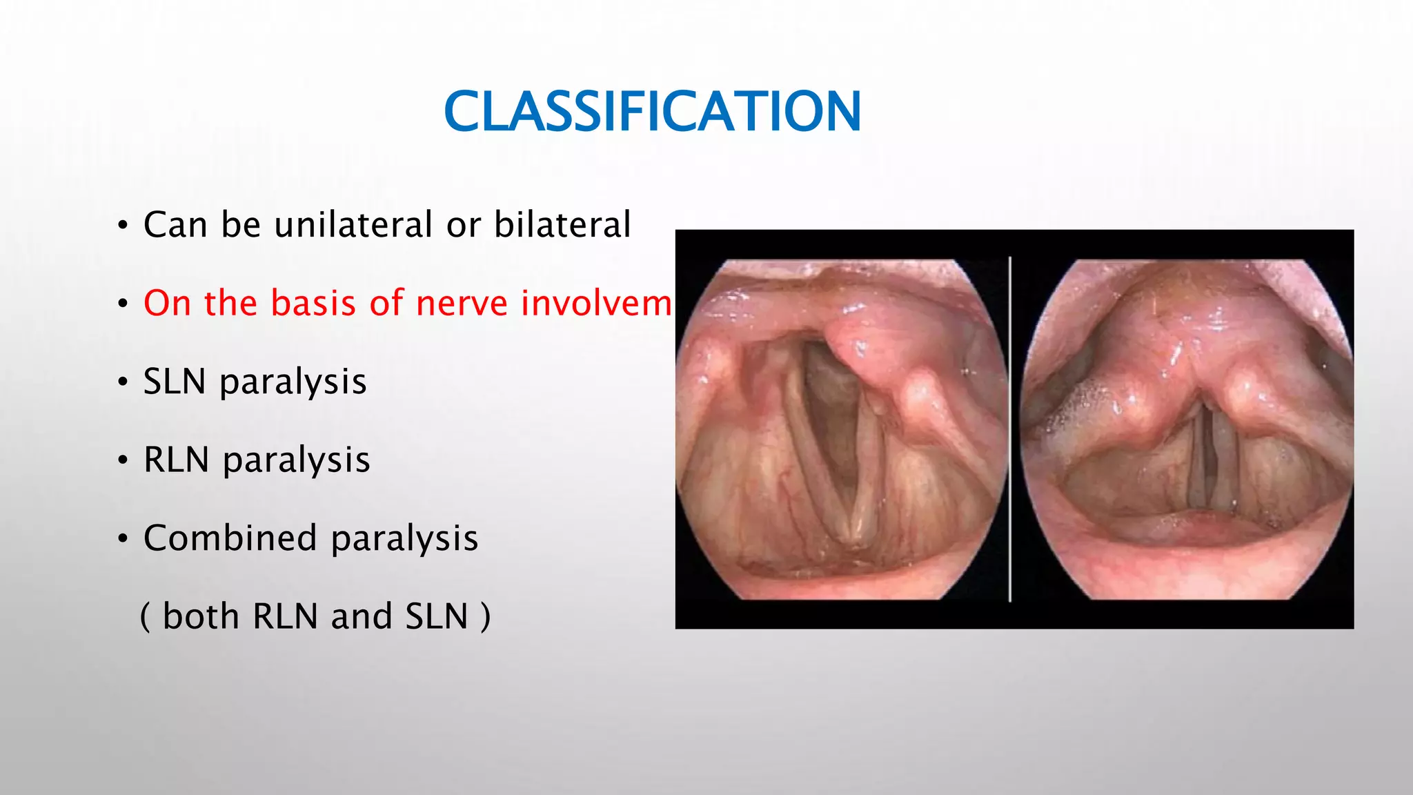 Vocal cord paralysis | PPTX