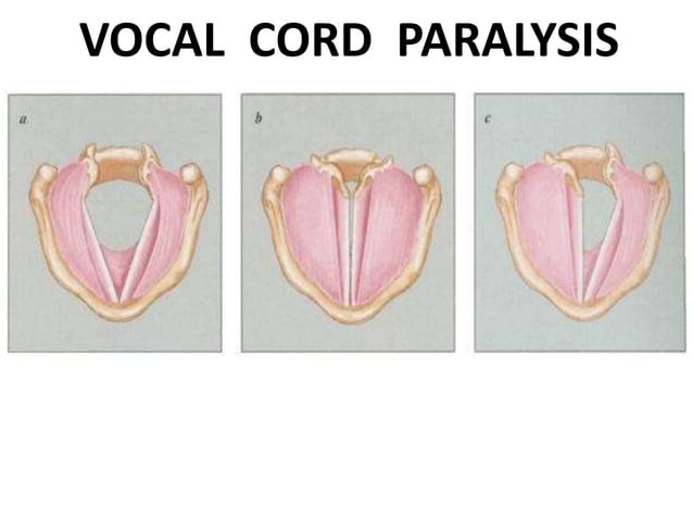 Vocal cord paralysis | PPTX | Ear, Nose and Throat Conditions | Diseases and Conditions