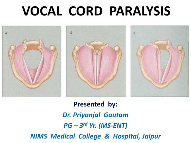 Vocal cord paralysis | PPTX | Ear, Nose and Throat Conditions ...