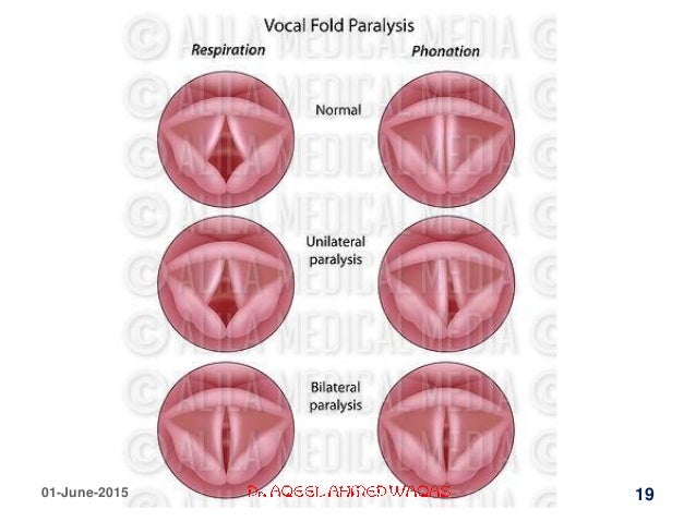 Vocal Cords Movements by Dr. Aqeel Ahmed Waqas (AIMC/JHL)
