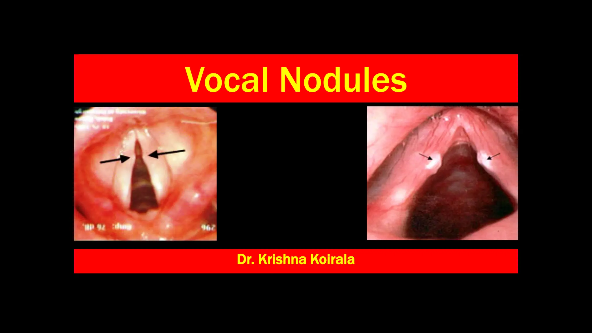 Vocal Nodules .pptx