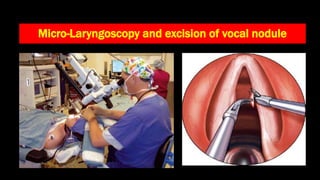 Vocal Nodules .pptx