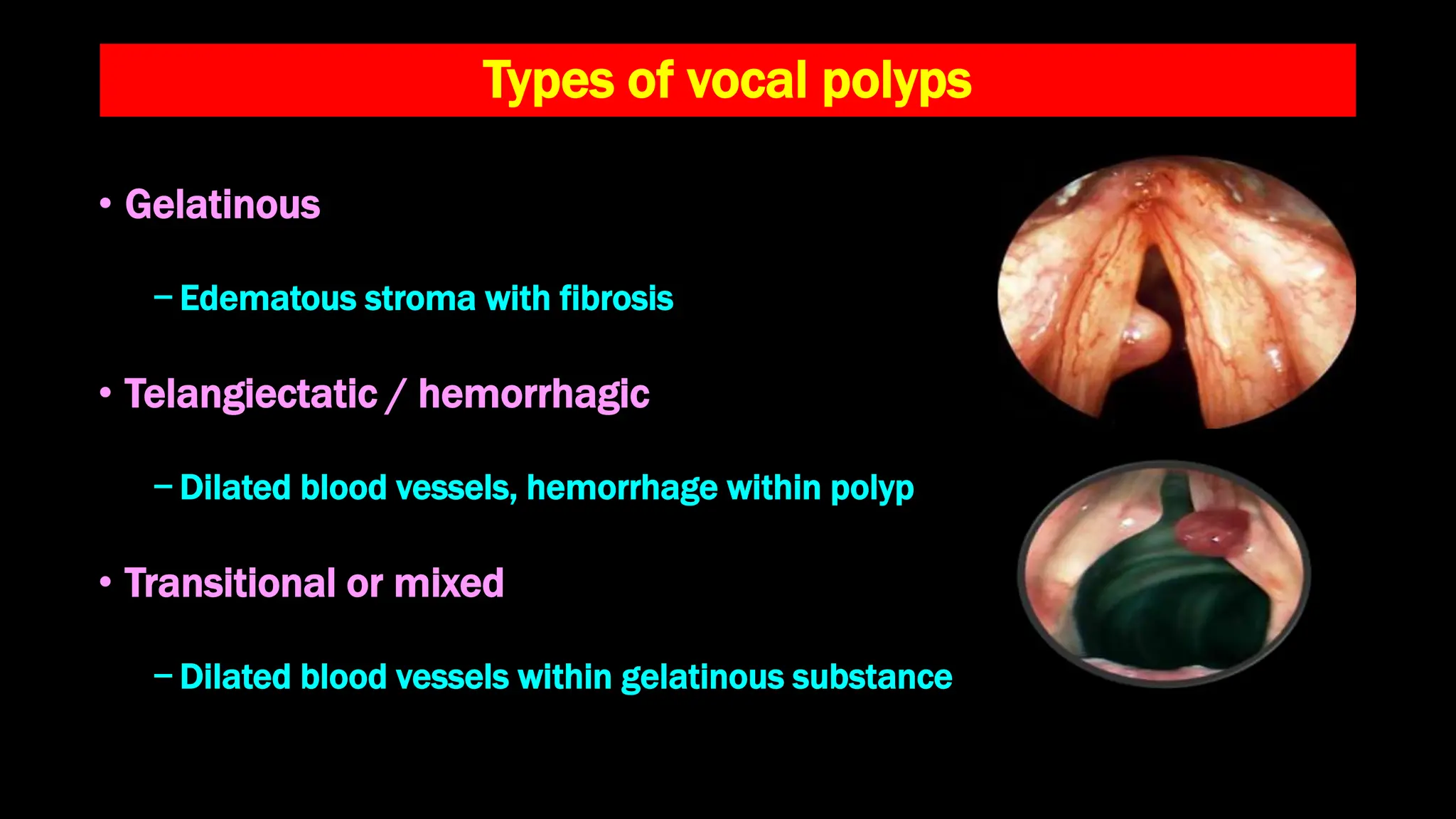 Vocal polyp.pptx