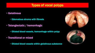 Vocal polyp.pptx