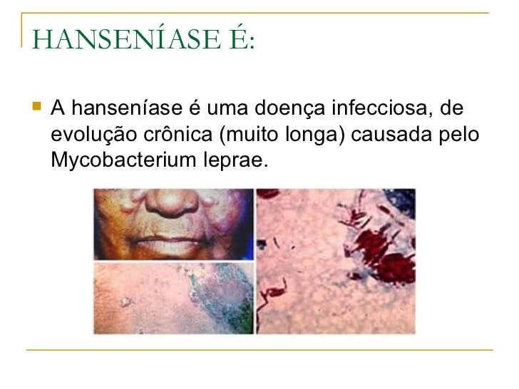 Você sabe o que é hanseníase