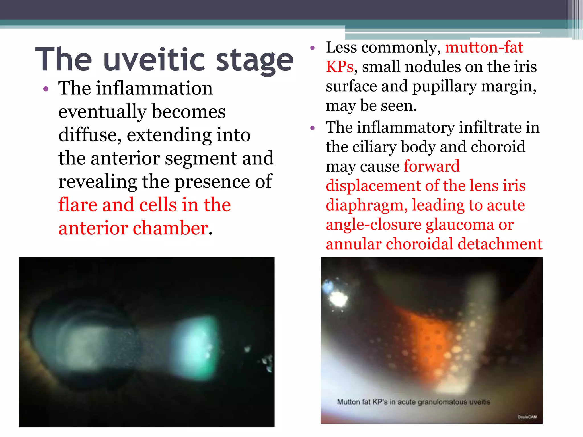 Vogt Koyanagi Harada Disease | PPTX