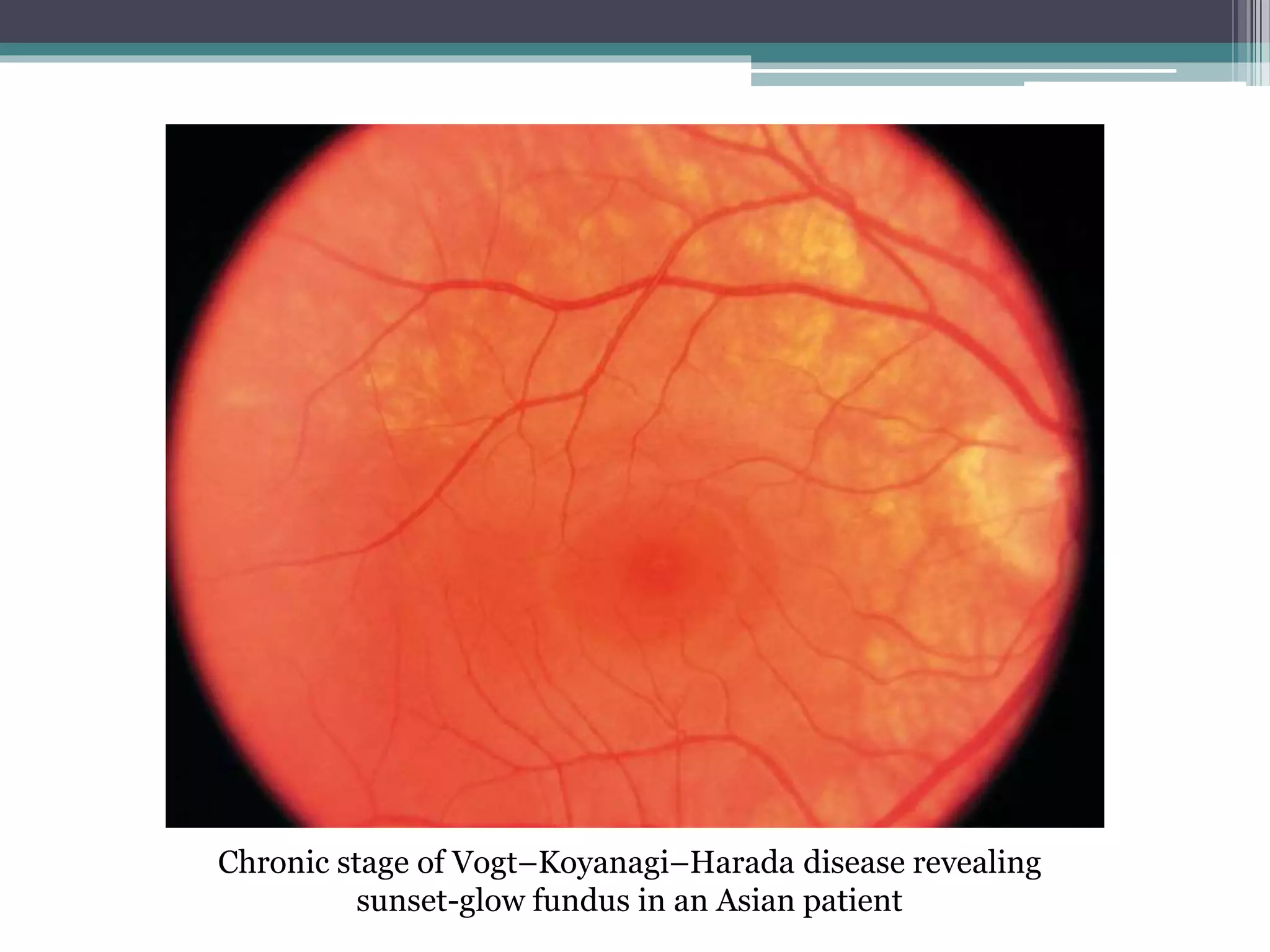 Vogt Koyanagi Harada Disease | PPTX