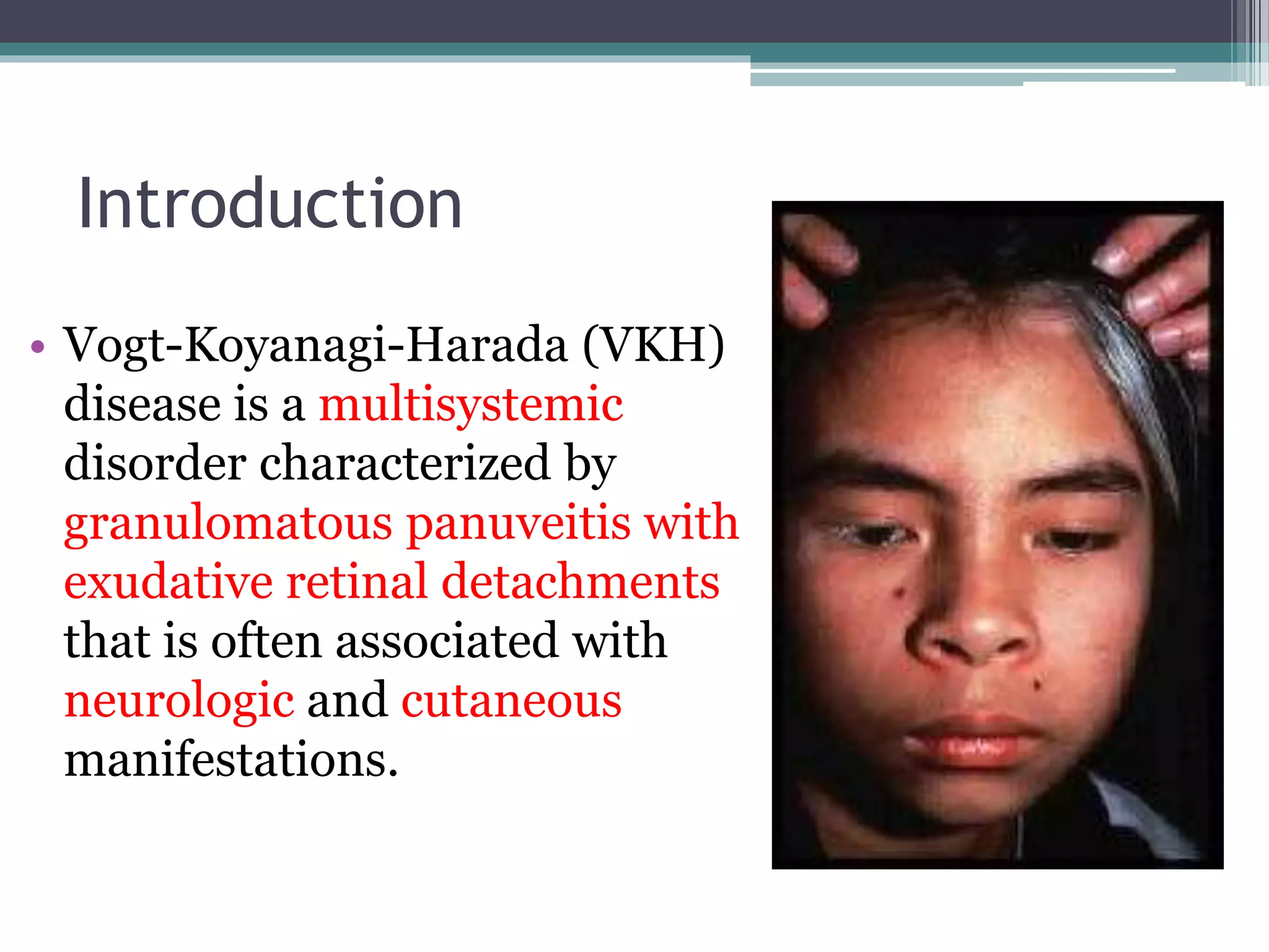 Vogt Koyanagi Harada Disease | PPTX