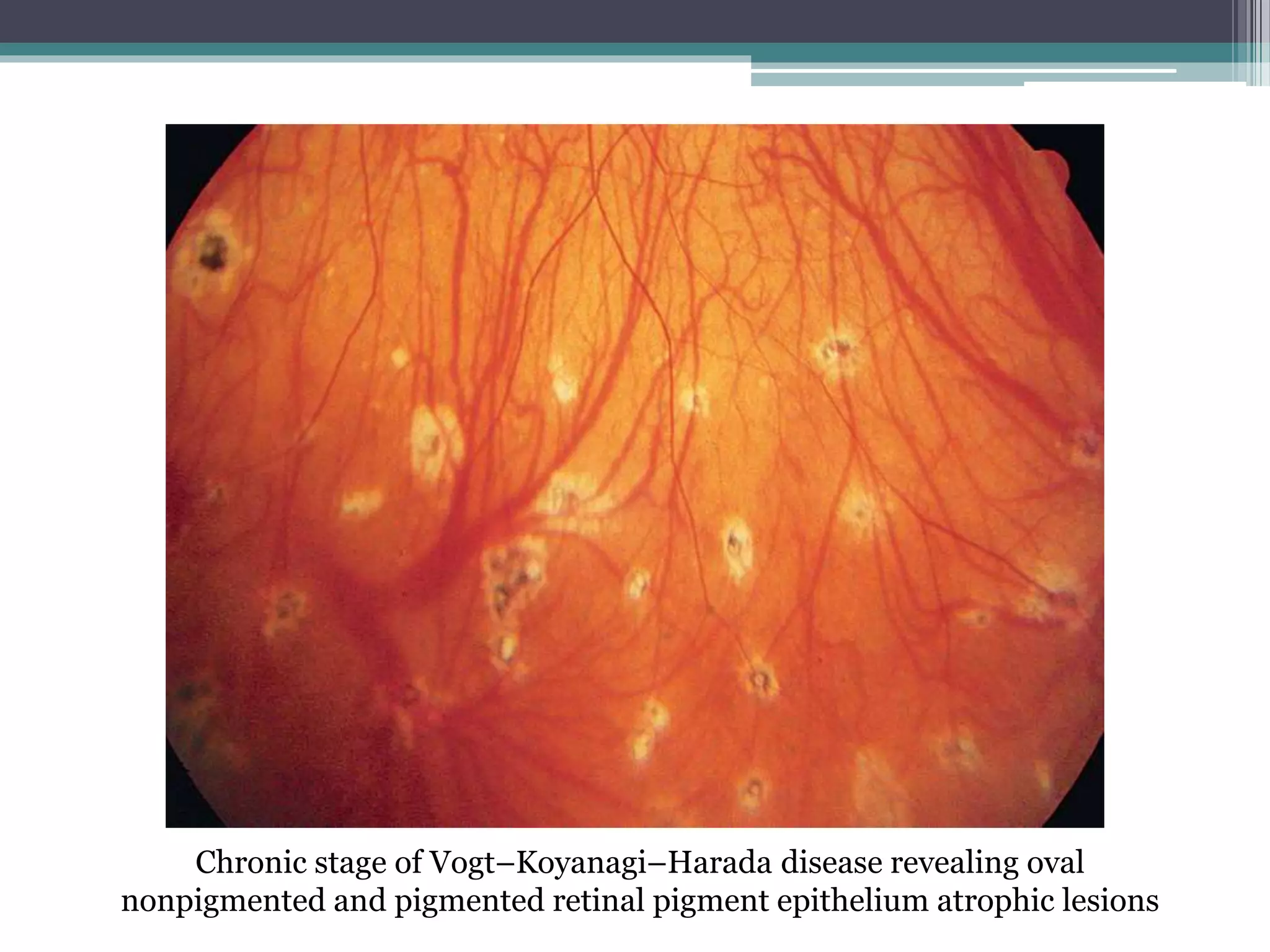 Vogt Koyanagi Harada Disease | PPTX