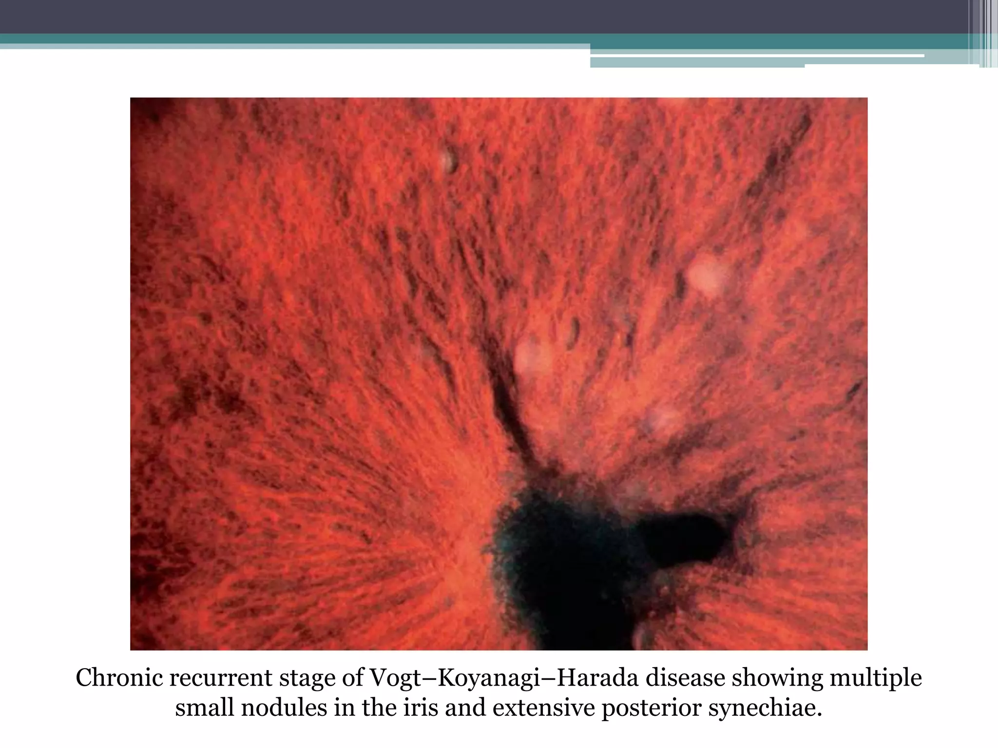 Vogt Koyanagi Harada Disease | PPTX