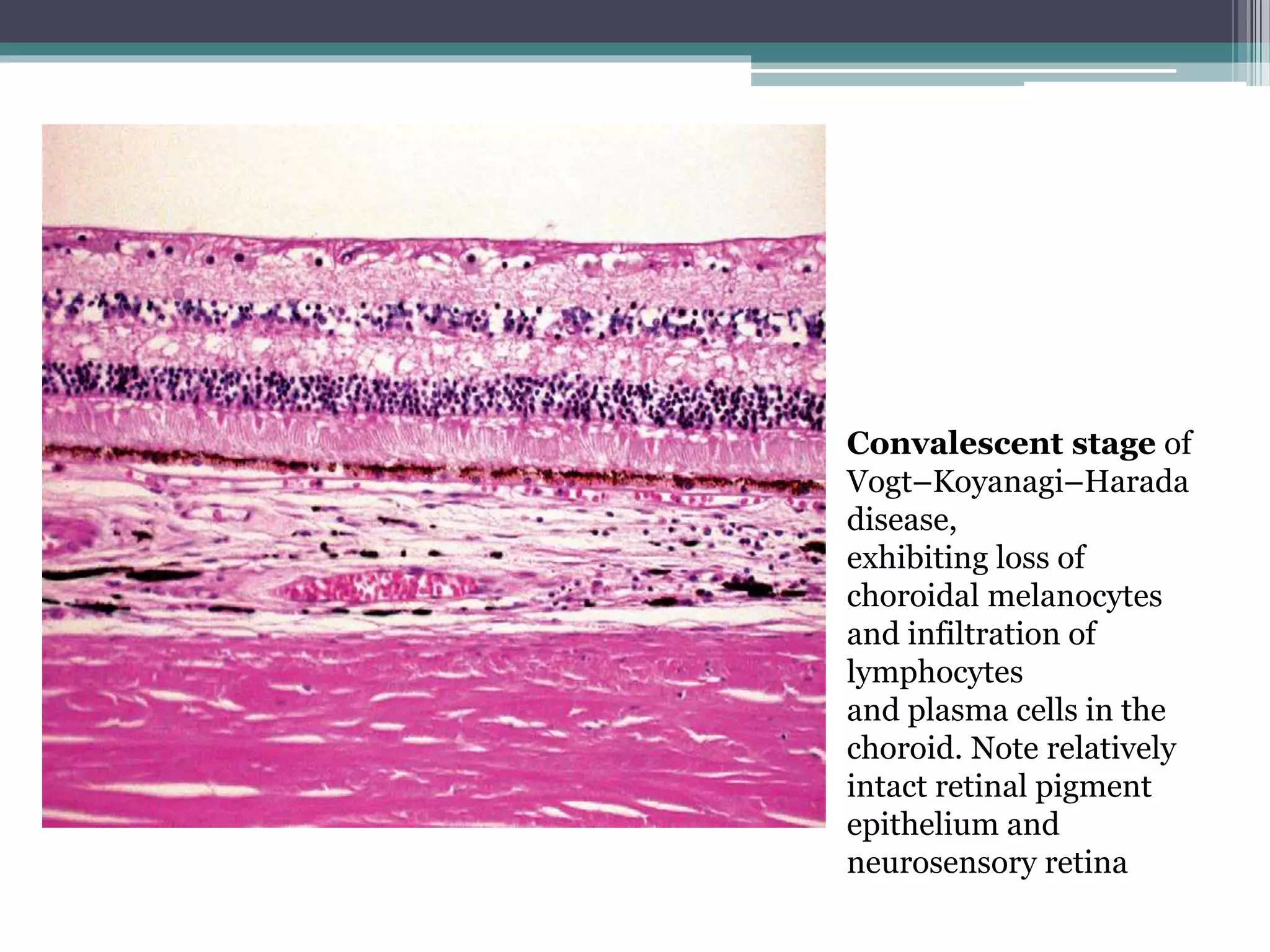 Vogt Koyanagi Harada Disease | PPTX