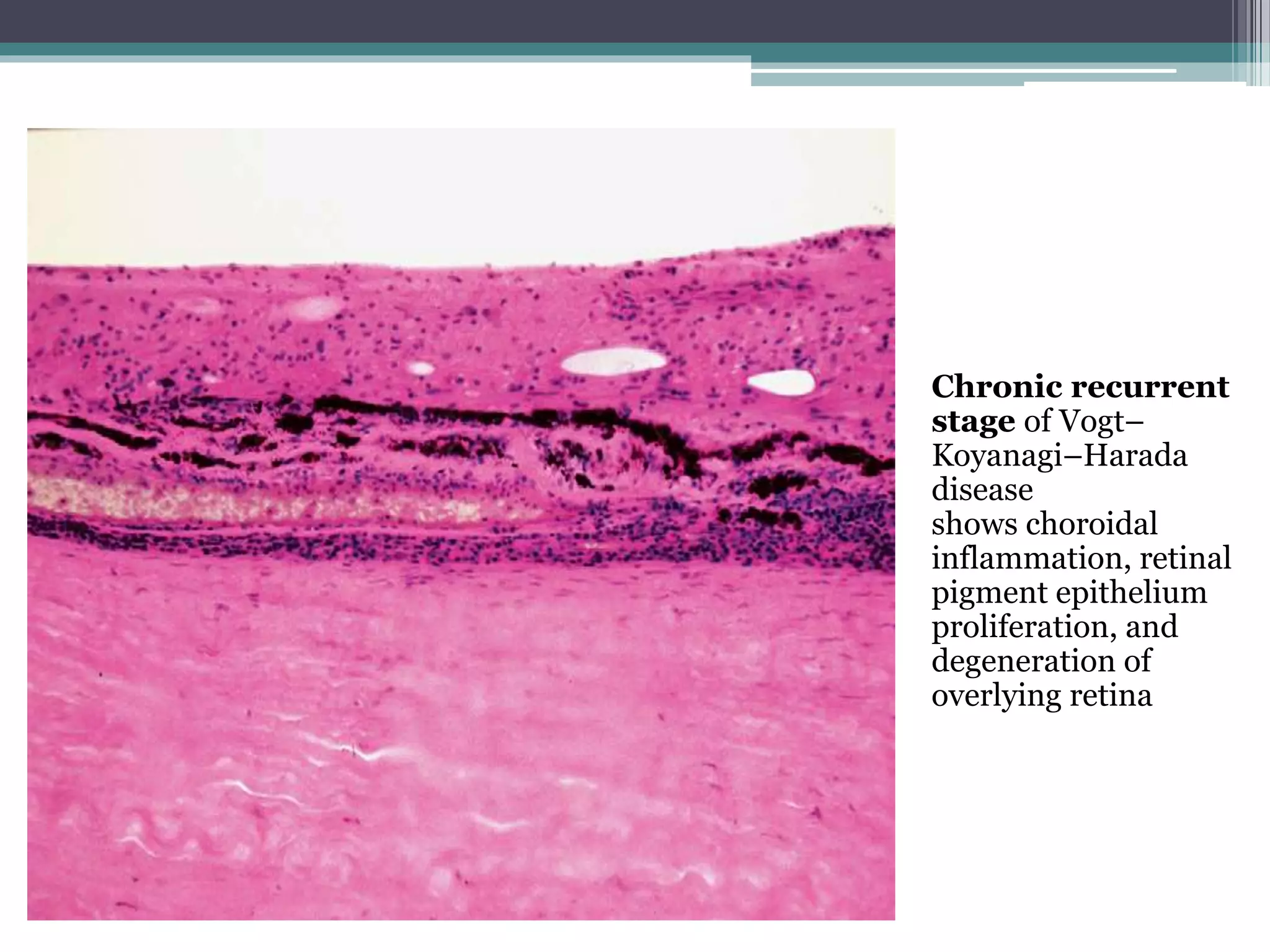 Vogt Koyanagi Harada Disease | PPTX