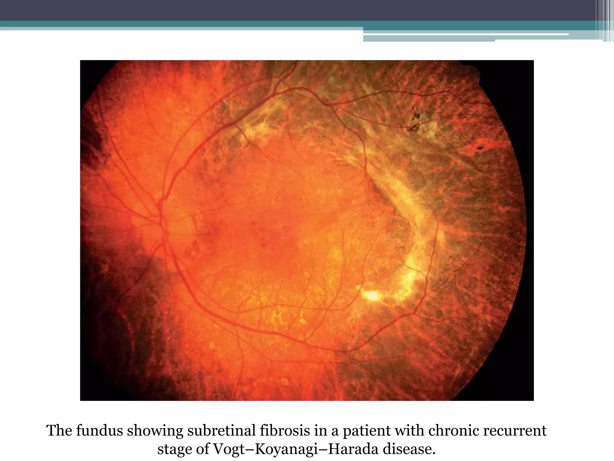 Vogt Koyanagi Harada Disease | PPTX