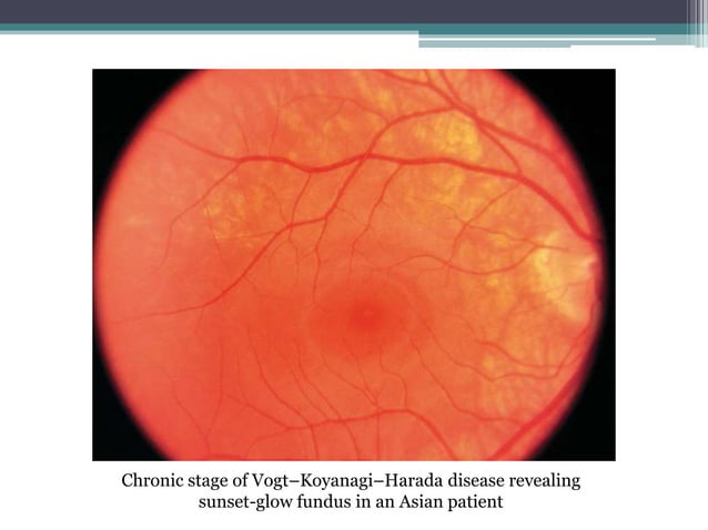Vogt Koyanagi Harada Disease | PPTX | Eye and Vision Conditions ...