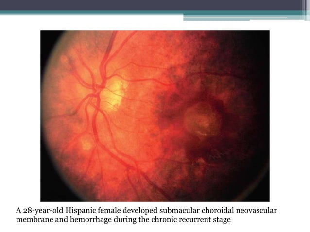 Vogt Koyanagi Harada Disease | PPTX | Eye and Vision Conditions ...