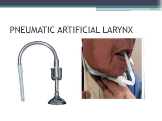 voice rehabilitation in total laryngectomy | PPTX