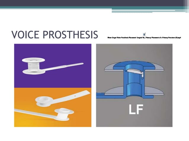 voice rehabilitation in total laryngectomy | PPTX