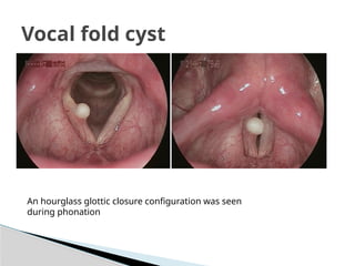 voice disorders AmmanAnatomy and P .pptx