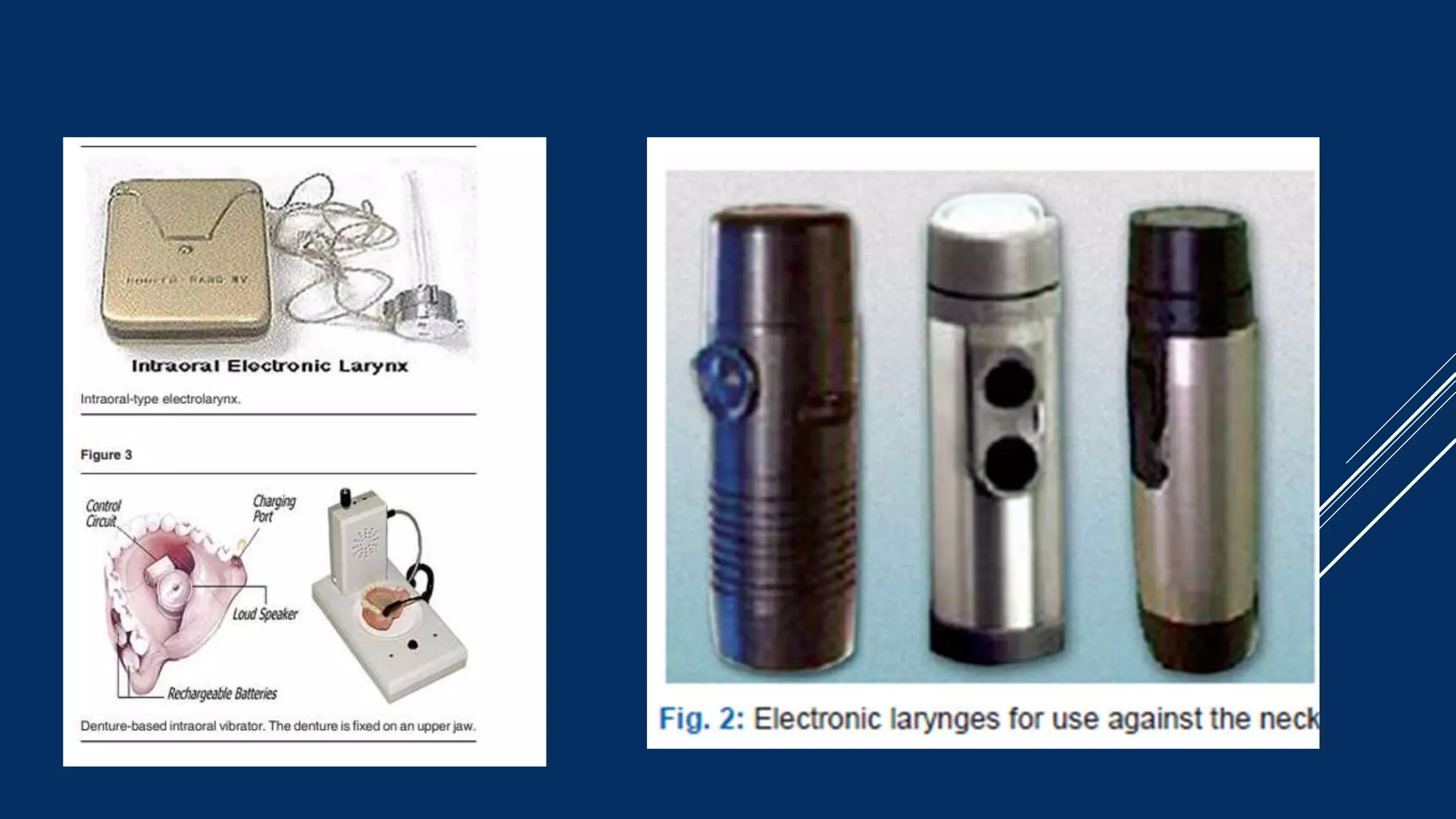 Voice rehabilitation after total laryngectomy.pptx