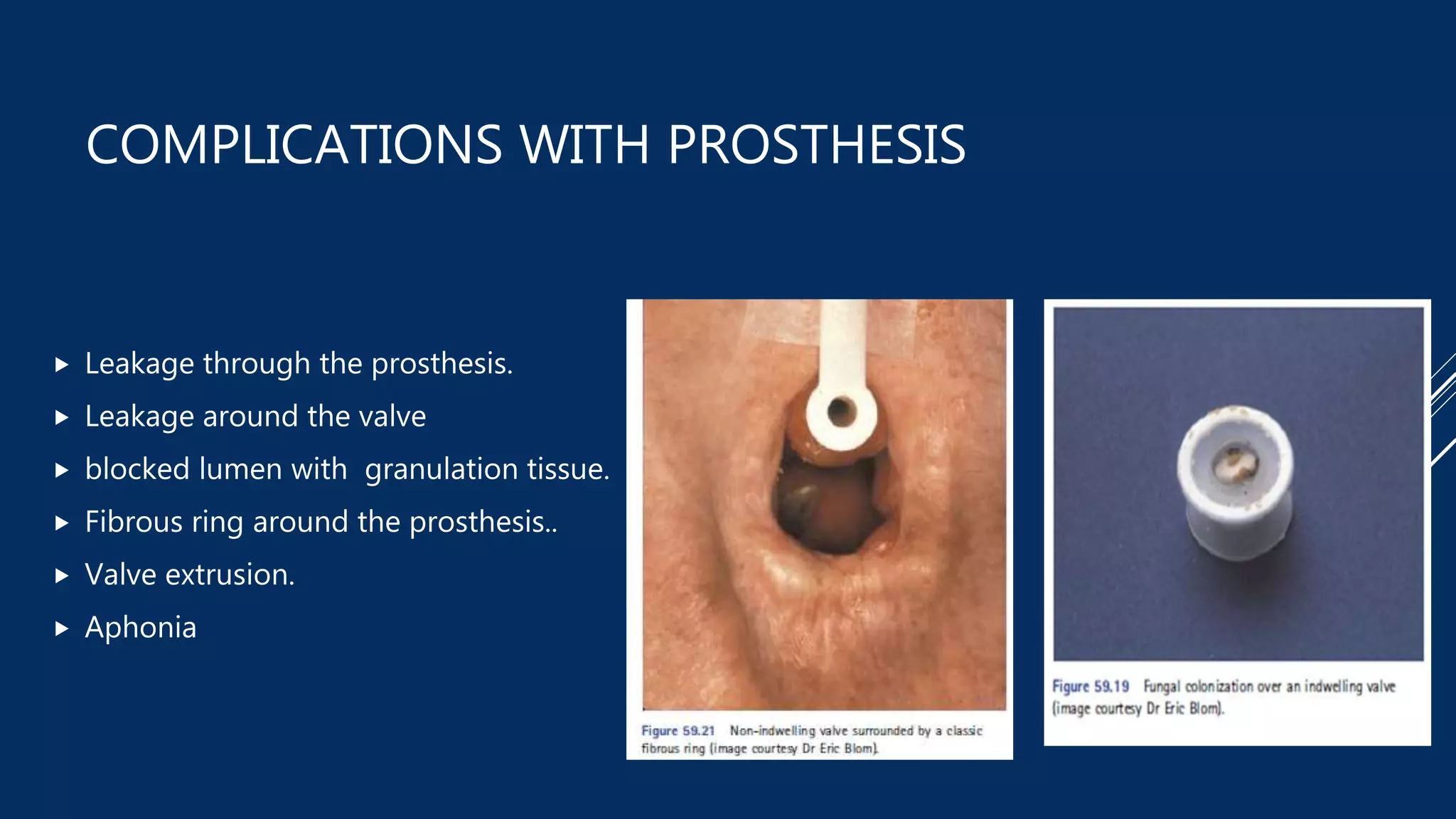 Voice rehabilitation after total laryngectomy.pptx