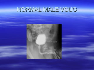 Voiding cystourethrography | PPT