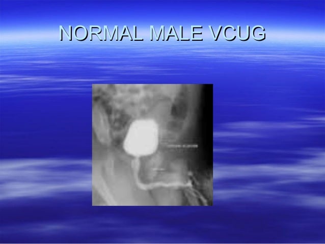 Voiding Cystourethrography