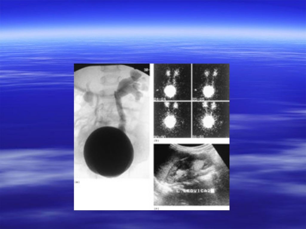 Voiding Cystourethrography