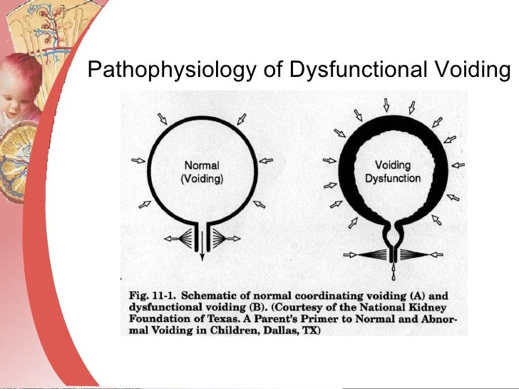Voiding Disorders In Children