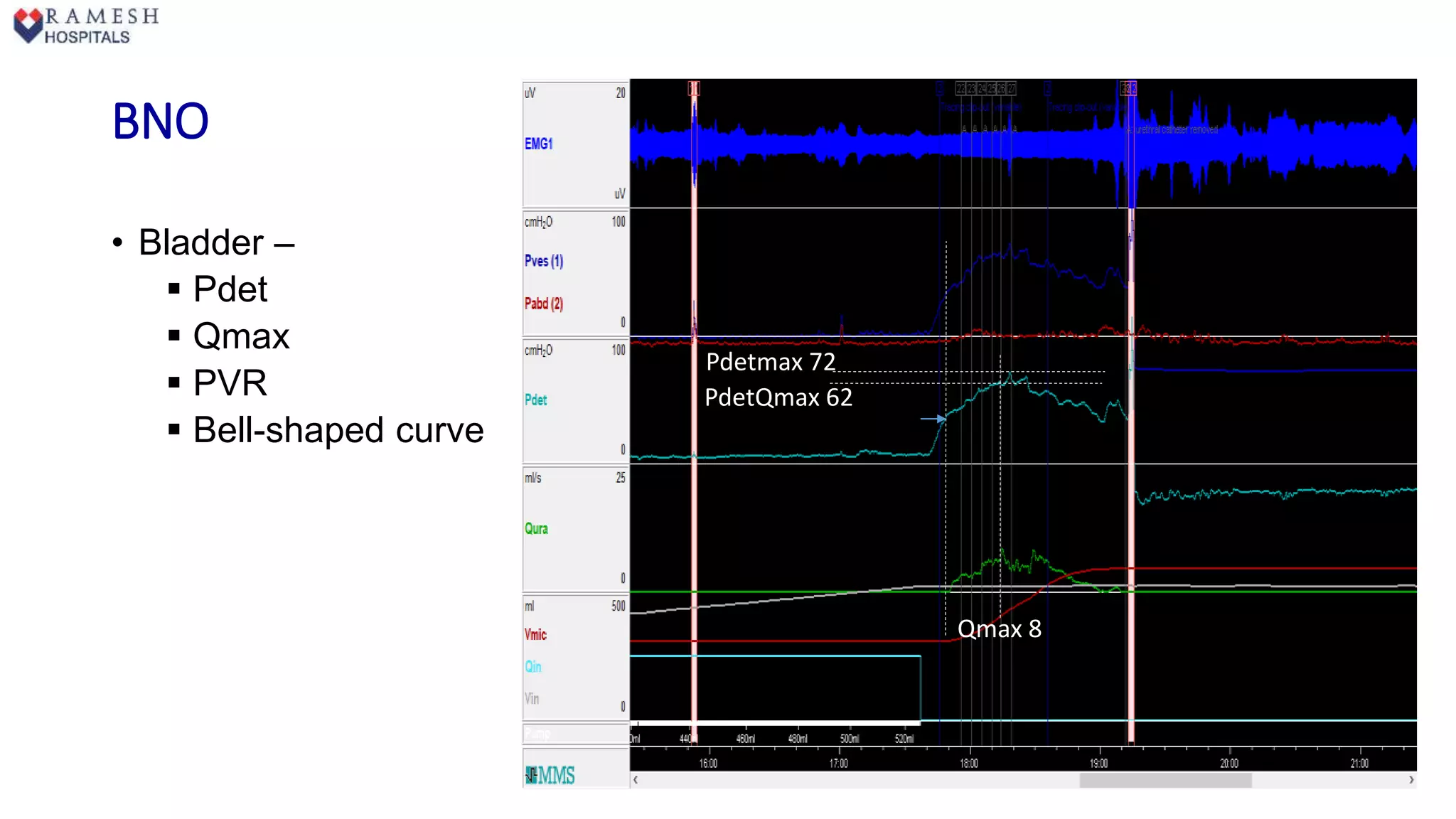 Voiding dysfunction in female final presentation | PPTX