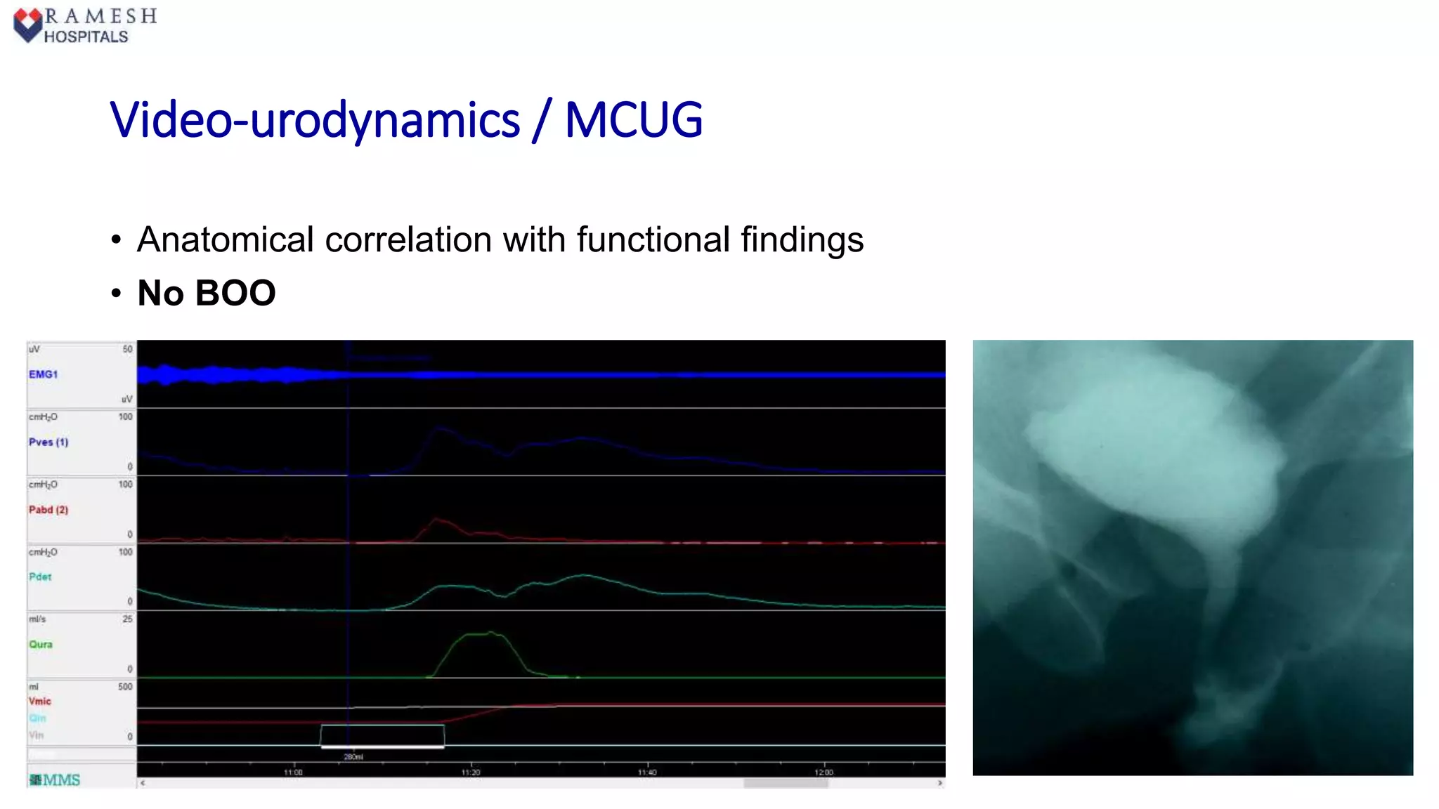 Voiding dysfunction in female final presentation | PPTX