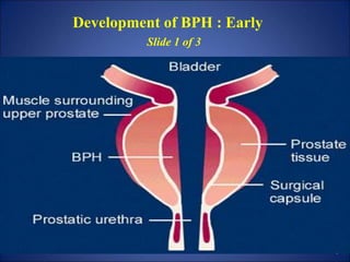 VOIDING DYS TEACHING Overactive_Bladder management plane..ppt