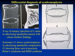 Syndesmophytes Vs Osteophytes