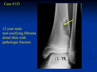 Ossifying Fibroma Tibia