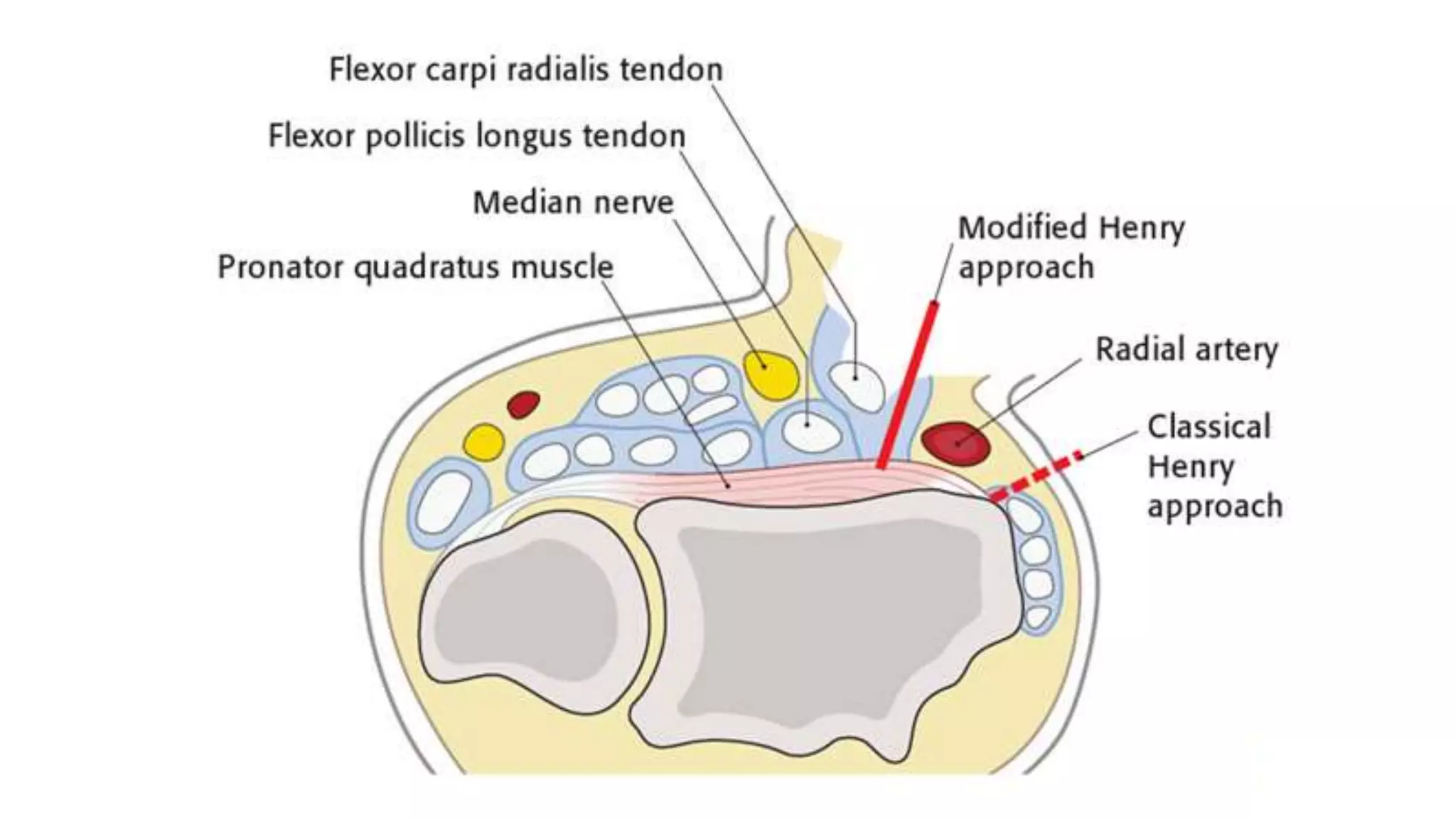 VOLAR APPROACH TO WRIST.pptx | First Aid | Injuries