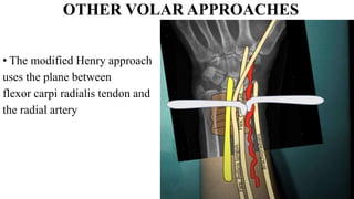 VOLAR APPROACH TO WRIST.pptx | First Aid | Injuries
