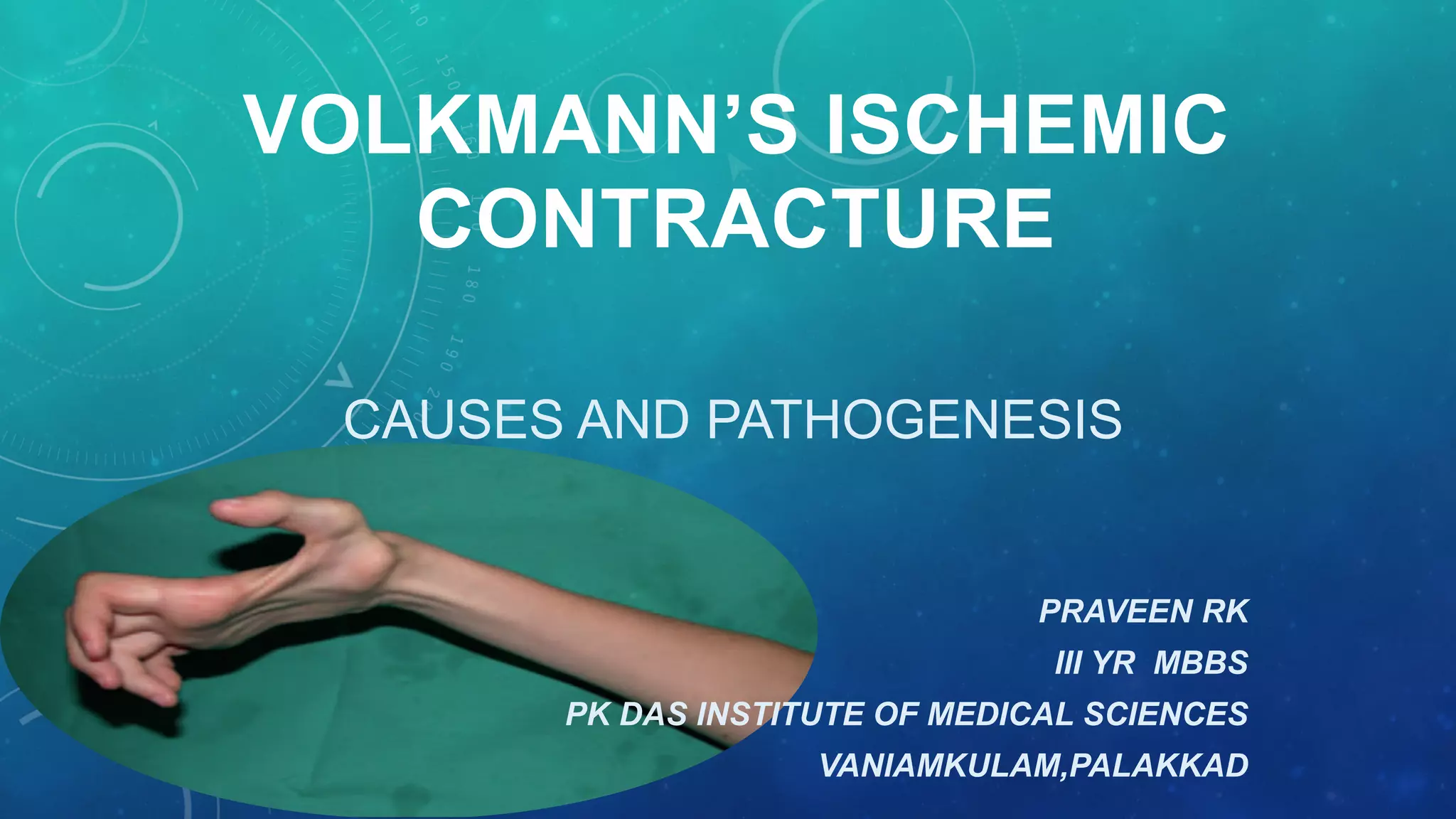Causes Of Volkmann's Ischemic Contracture