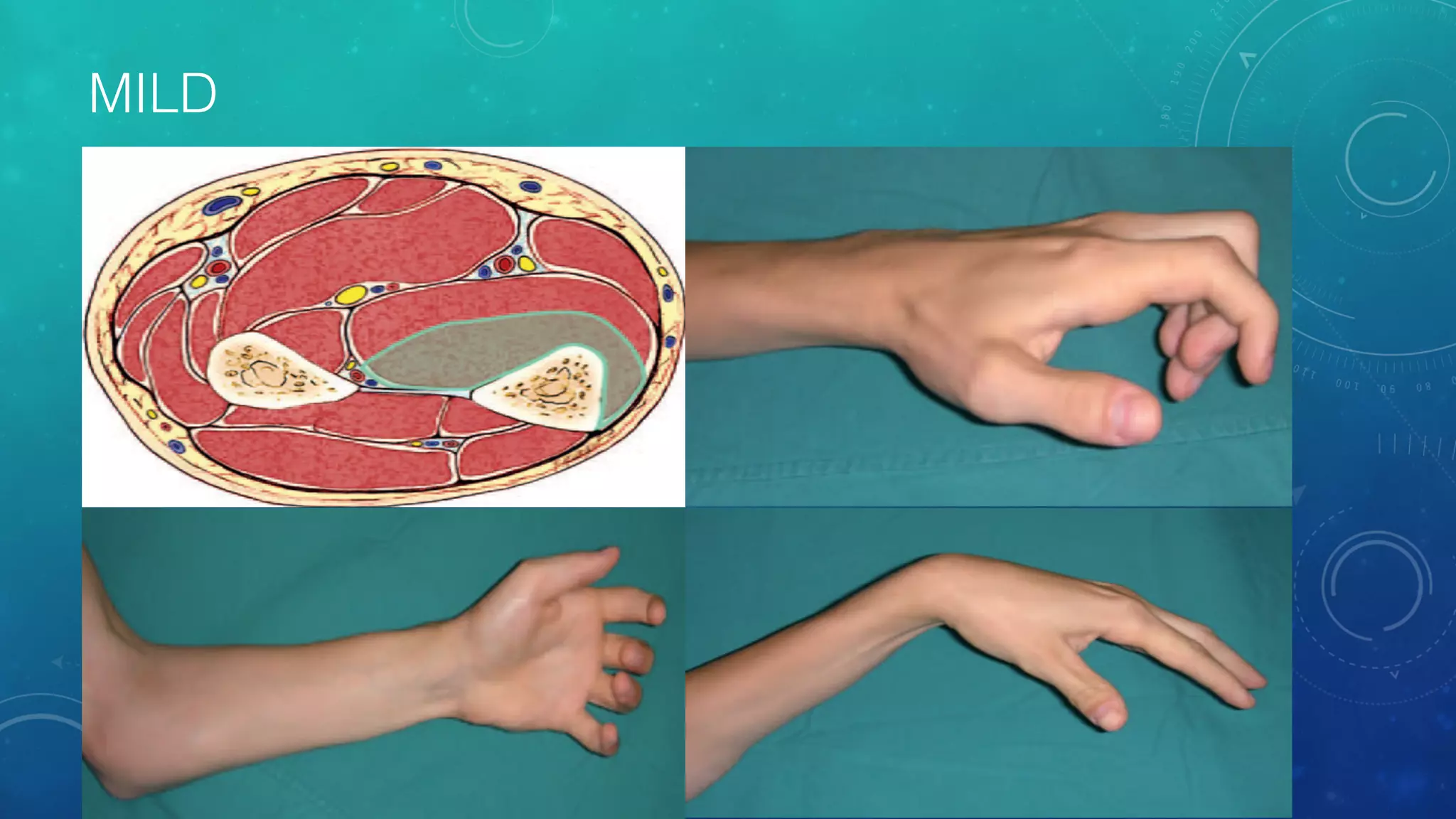 Volkmann contracture