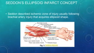 Volkmann contracture | PDF