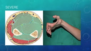 Volkmann contracture | PDF