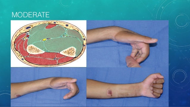 Volkmann contracture