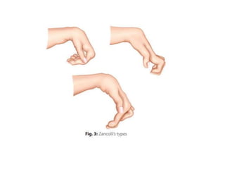 VOLKMANN ISCHEMIC CONTRACTURE SEMINAR.pptx