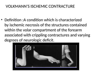 volkmannsischemiccontracture-171220111547.pptx