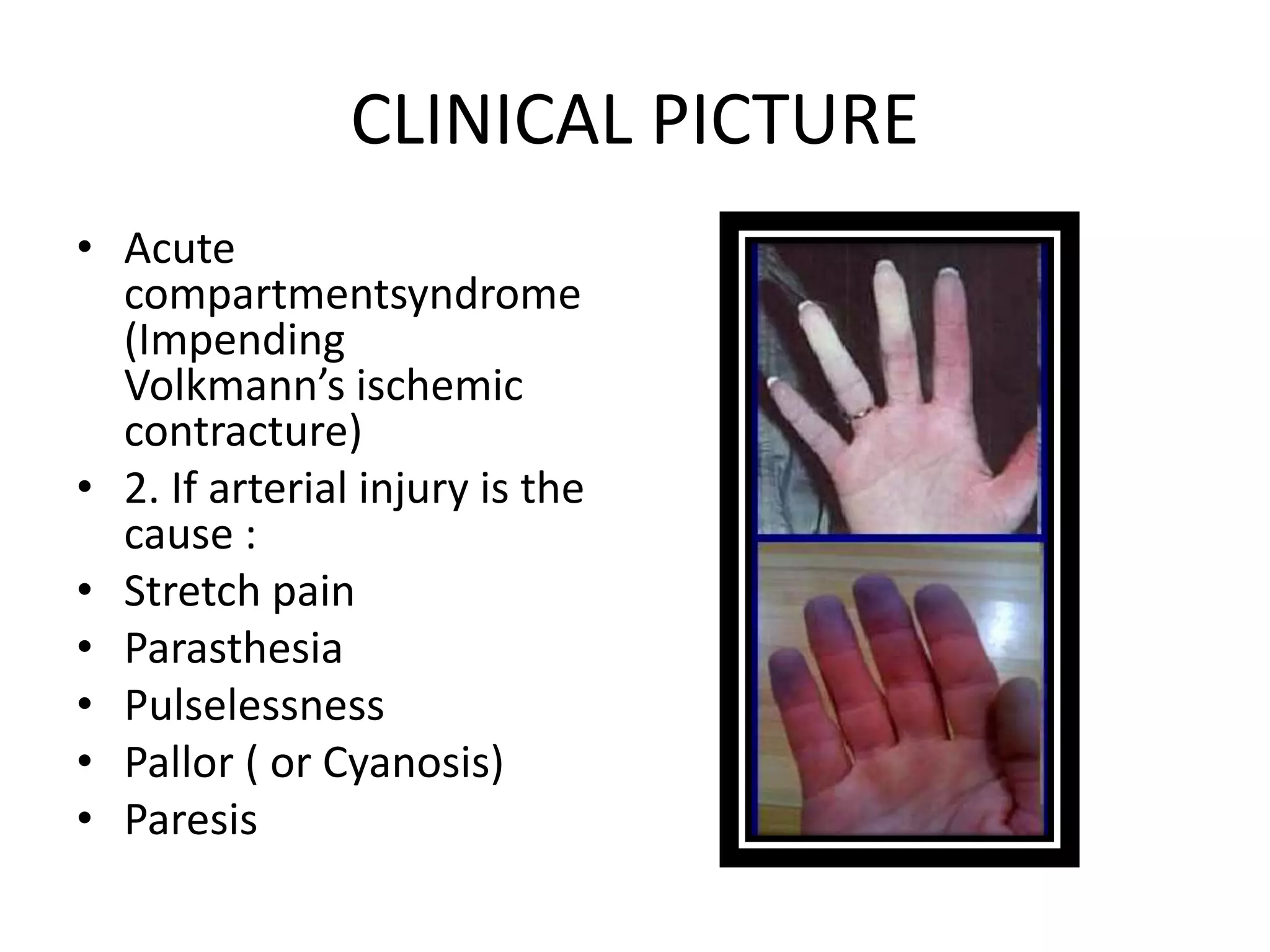 Causes Of Volkmann's Ischemic Contracture