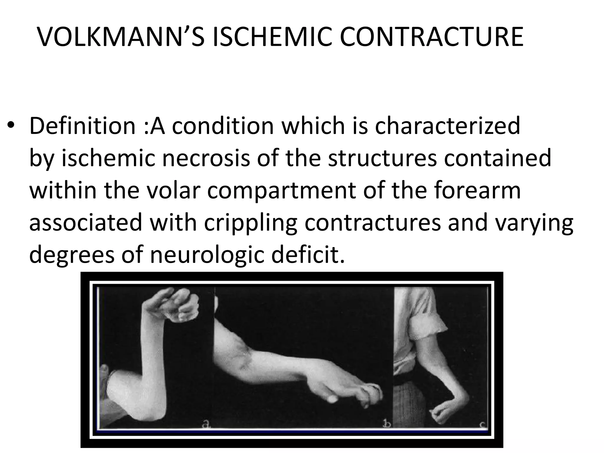 Volkmann¶s ischemic contracture | PPTX